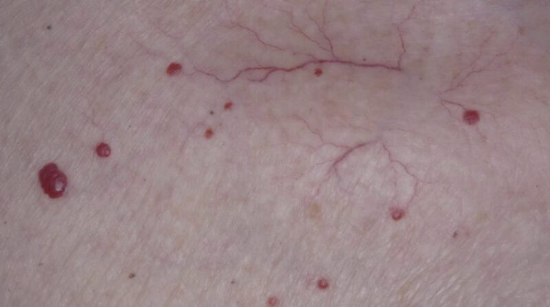 Red spots appeared on my mom’s back and kept growing every day — we had ...